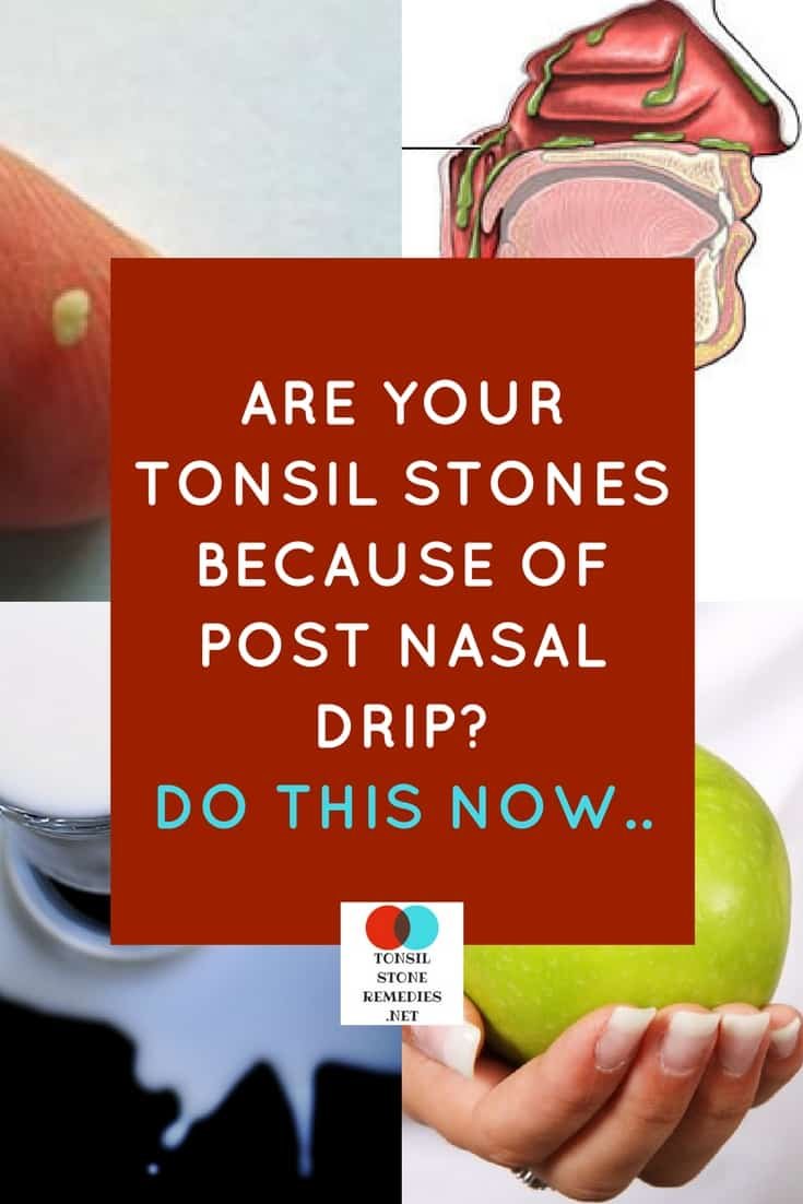 Are Your Tonsil Stones Because Of Post Nasal Drip Do This Now 