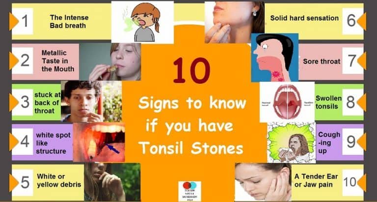 How do you know if you have Tonsil stones? The 10 Signs