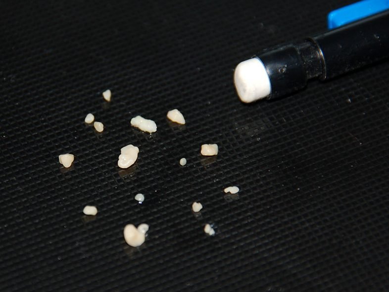Tonsil stones & Allergies: Can allergies cause Tonsil stones in your ...